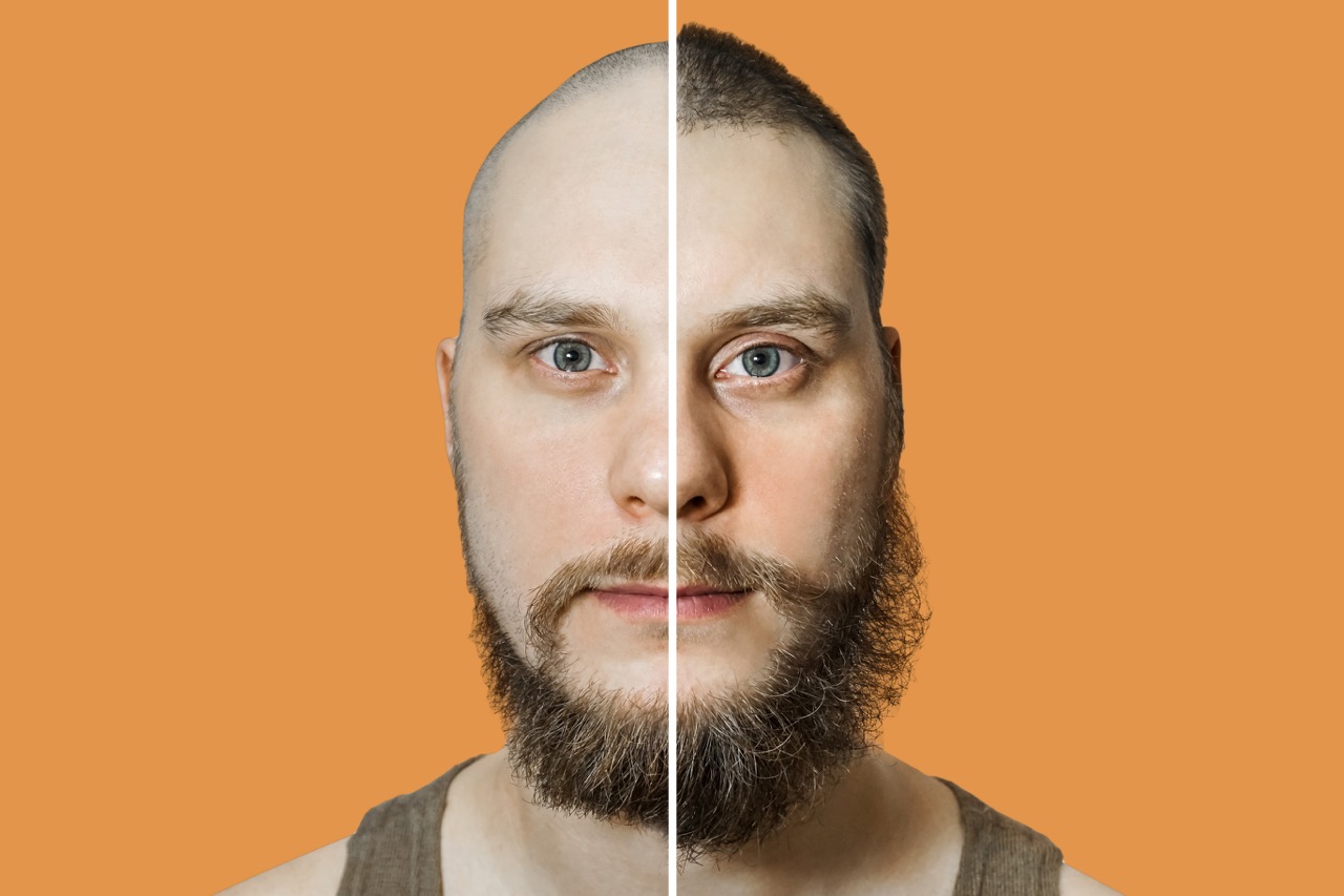 Hair Transplant Cost in Turkey 2026: Real Prices & Comparison ...